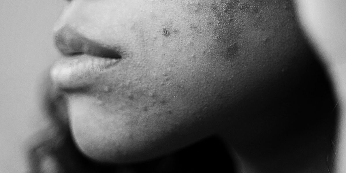 14 Best Benzoyl Peroxide Washes - Vibrant Dermatology